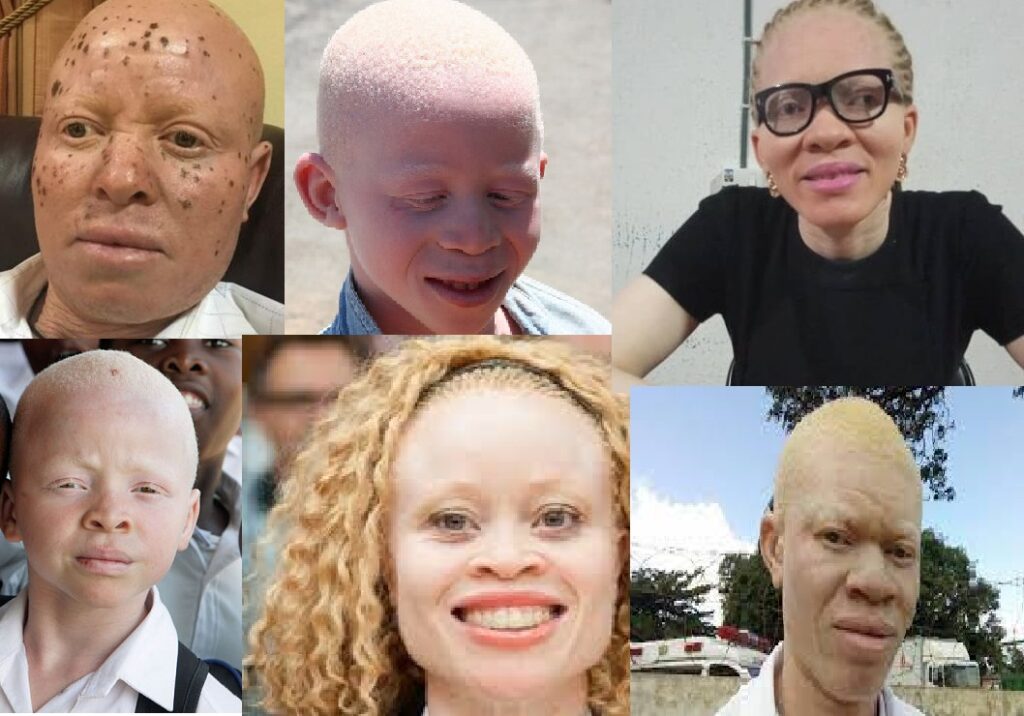 How Discrimination Adversely Affects Persons with Albinism ...